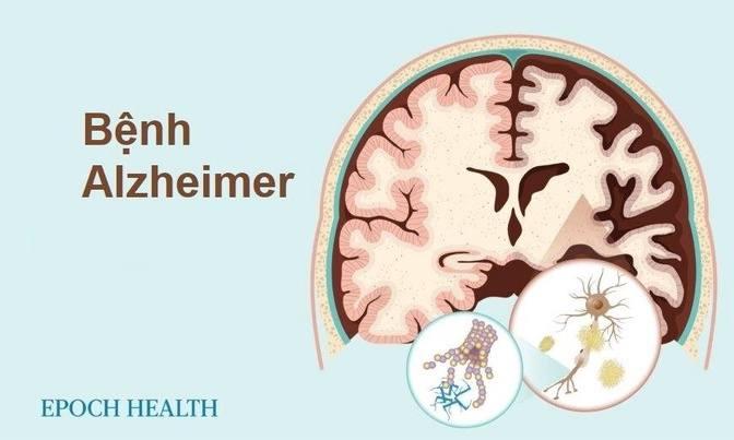 2-Hướng dẫn cơ bản về bệnh Alzheimer: Triệu chứng, nguyên nhân, điều ...